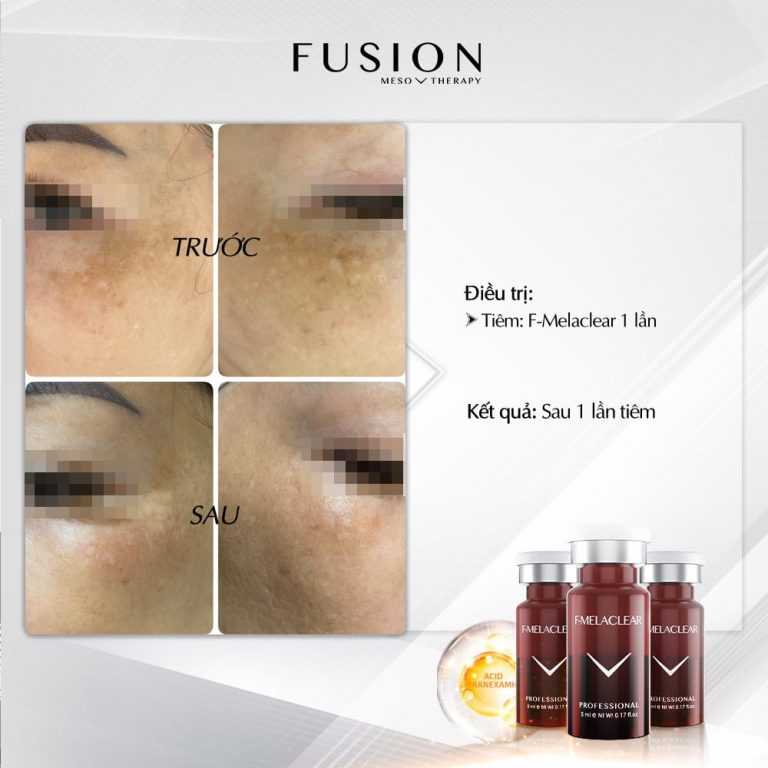 Tiêm điều trị nám và tàn nhang Fusion Meso F-Melaclear 5 lọ | Ed beauty