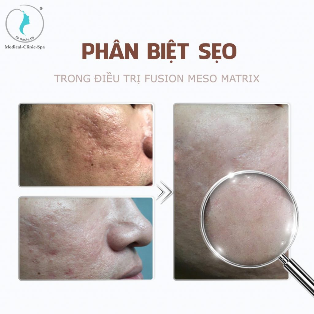 FUSION MESO MATRIX - BÍ KÍP ĐÁNH BAY SẸO RỖ ĐƯỢC BÁC SĨ TIN DÙNG