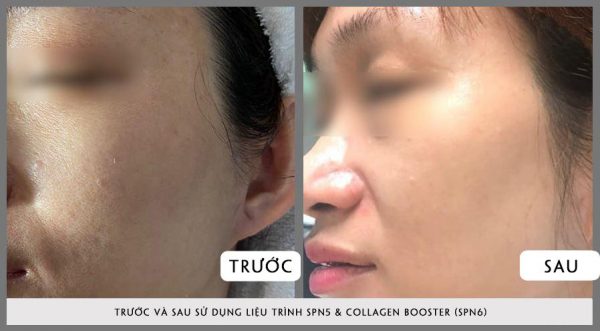 ĐẶC TÍNH NỔI BẬT CỦA SẢN PHẨM SPN-6 SRS MESOTHERAPY