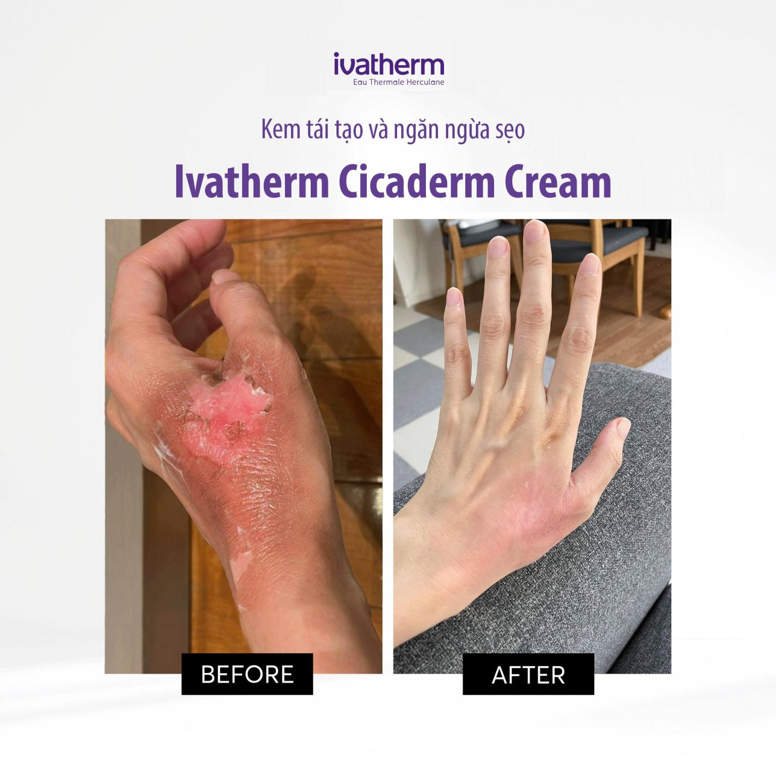 Ivatherm Cicaderm Cream Kem tái tạo và ngăn ngừa sẹo 40ml