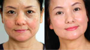 Exocode Radiance - R cấy làm sáng da và điều trị nám