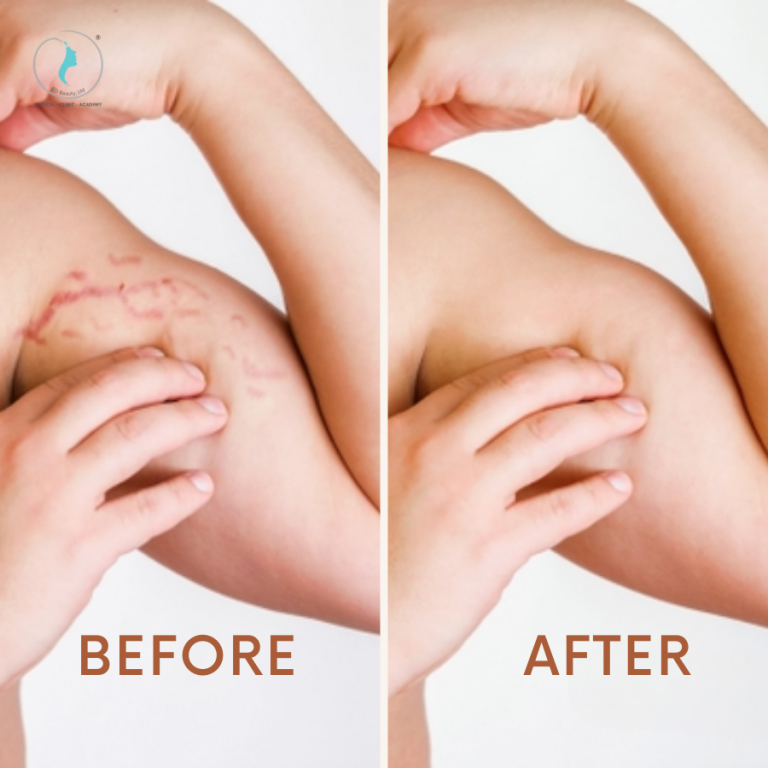 Kem trị rạn da và chống sẹo Stretcheal Anti Stretch Marks & Scars Cream ...