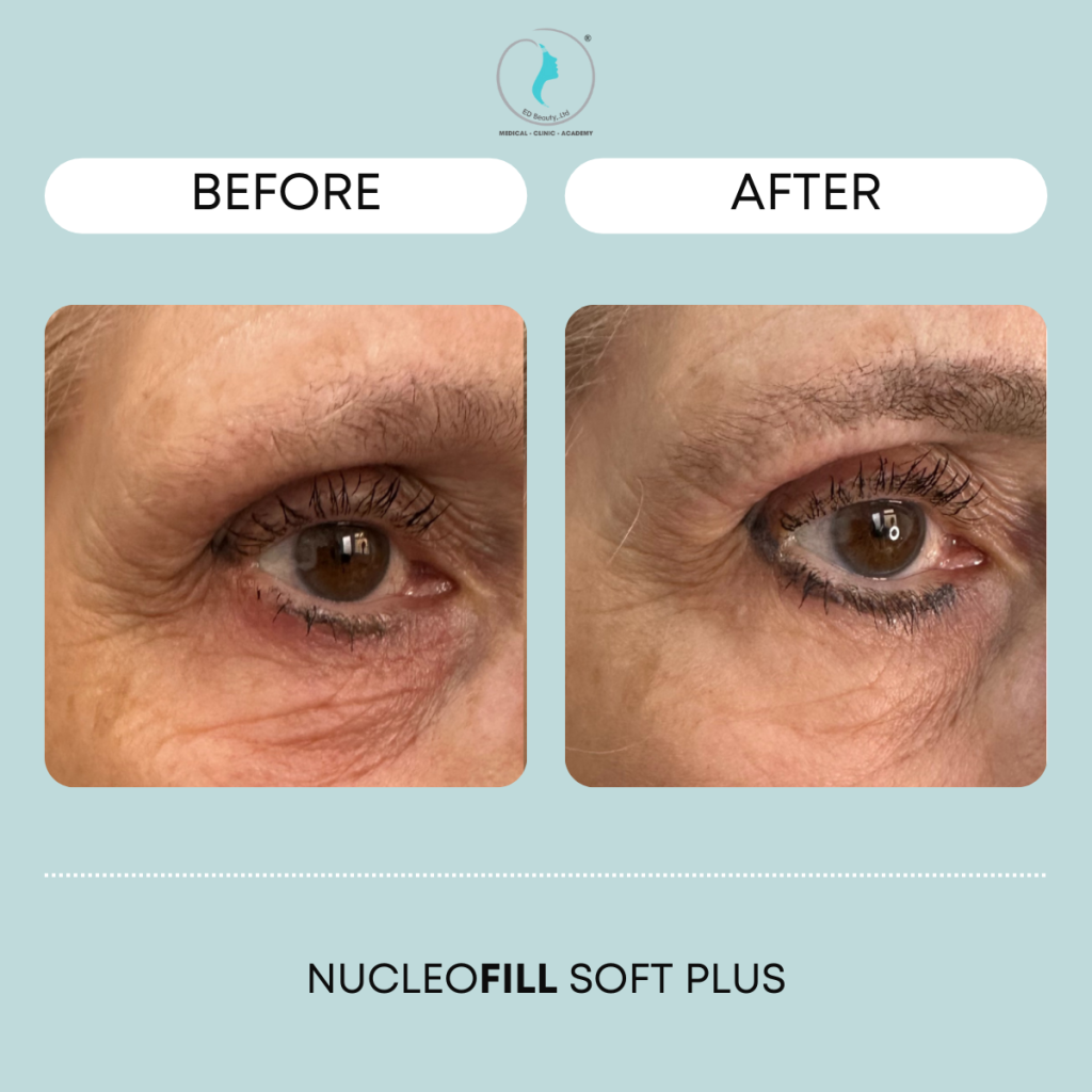 NUCLEOFILL SOFT PLUS - Điều trị quầng thâm & nếp nhăn | Ed beauty