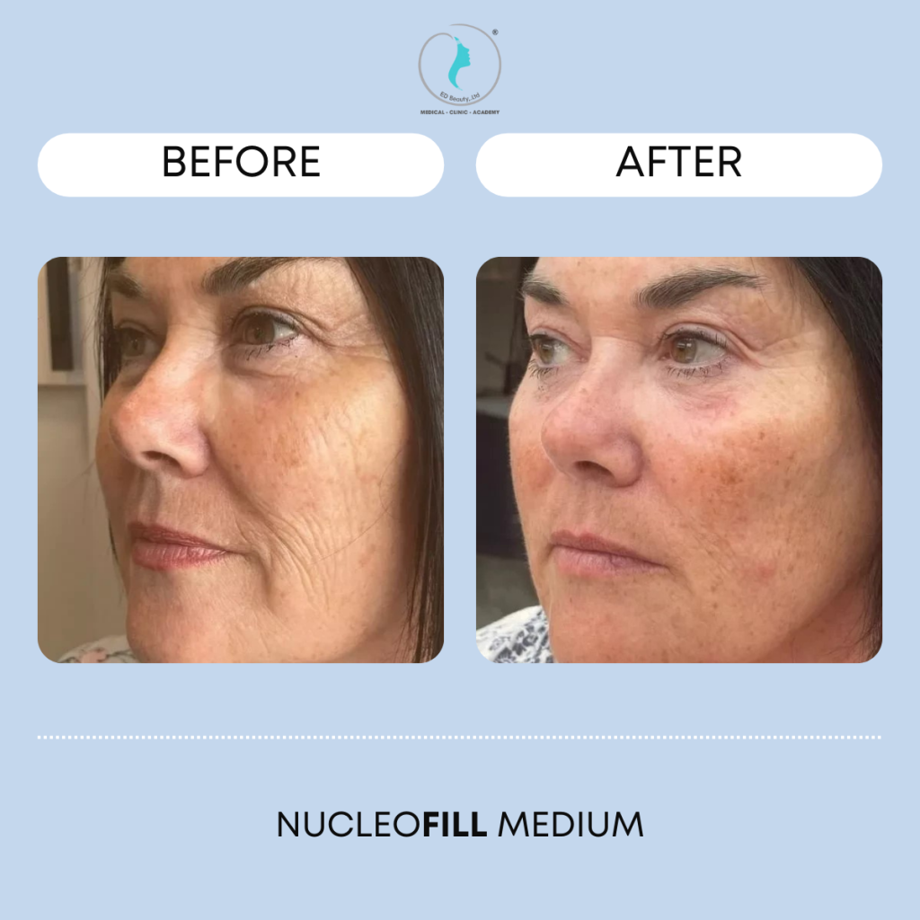 NUCLEOFILL MEDIUM - Liệu pháp trẻ hóa da | Ed beauty
